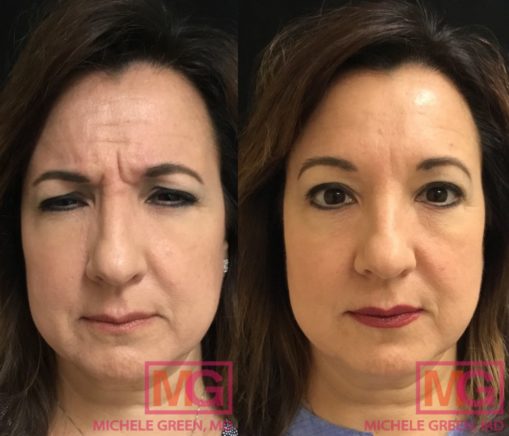 Botox Before & After Photos, Patient Photo, Pictures