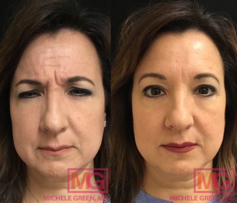 Botox Before & After Photos, Patient Photo, Pictures