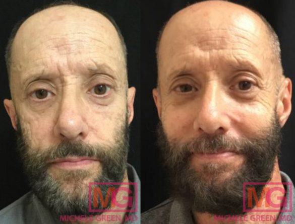 Sculptra Before & After Photos - Dr. Michele Green M.D.