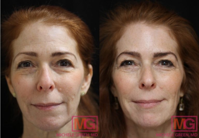 Restylane Before & After Photos, Lyft, Under Eyes & Cheeks