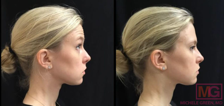 Botox Before & After Photos, Patient Photo, Pictures