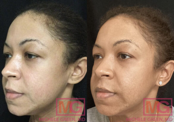 Microneedling Before & After Photos - Dr. Michele Green M.D. Microneedling Before & After Photos - Dr. Michele Green M.D.