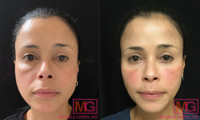 Hyaluronidase NYC, Injections to Reverse Restylane & Juvederm Fillers