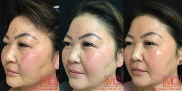 Melasma in Asian Skin - Dr. Michele Green M.D.