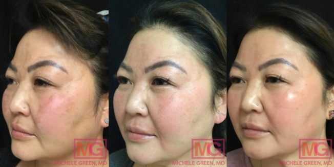 Sunspots on Asian Skin - Dr. Michele Green M.D. NYC