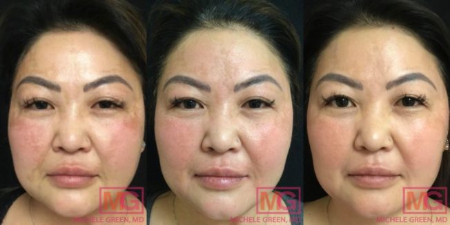 How to Cure Melasma from the Inside - Dr. Michele Green M.D. NYC