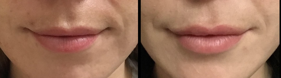 1 syringe Juvederm Ultra Plus to lips