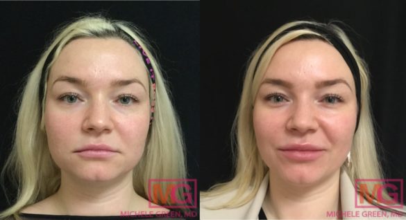 Vertical Lip Lines, Best Fillers & How To Reduce Vertical Lip Lines