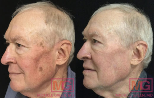 Removing Sun Spots On The Face - Dr. Michele Green M.D.