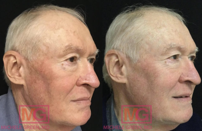 Fraxel Laser - Fraxel Laser Treatments, Fraxel Dual Laser NYC