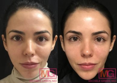 VBeam Before & After Photos - Dr. Michele Green M.D.