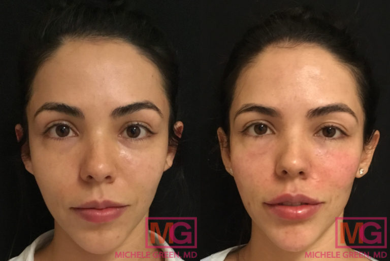 What is the Botox Lip Flip Procedure? - Dr. Michele Green M.D. NYC