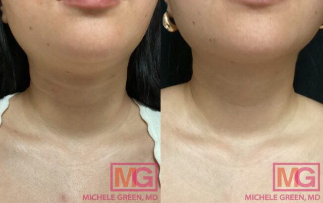 Sculptra Neck, Sculptra for Décolletage and Neck Rejuvenation - Dr ...