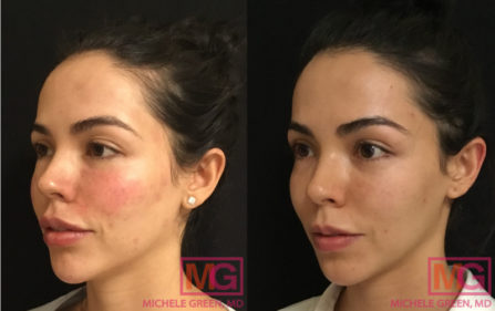 VBeam Laser NYC, V-Beam Laser Treatments - Dr. Michele Green M.D.