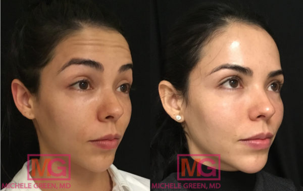 Botox in Your 20's & 30's - Dr. Michele Green M.D. NYC