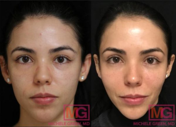 Bruising After Cheek Fillers, Causes And Prevention