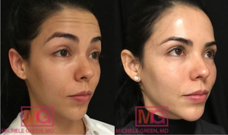 Botox Brow Lift, Forehead Lines, Hooded Eyes & Glabella