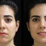 35 year old treated with Botox injections (Forehead, Glabella & Crows feet)