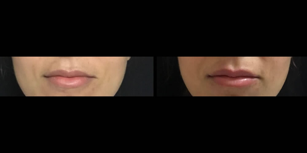 Restylane Before & After Photos, Lyft, Under Eyes & Cheeks