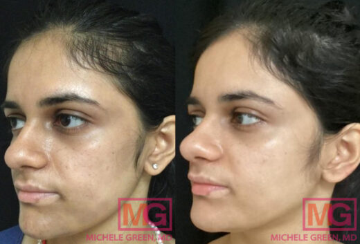 Facial Hyperpigmentation, Treatment for Hyperpigmentation from Sun ...