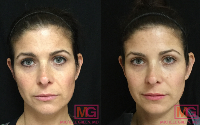 Restylane NYC, Restylane Injections & Fillers - Dr. Michele S. Green, MD
