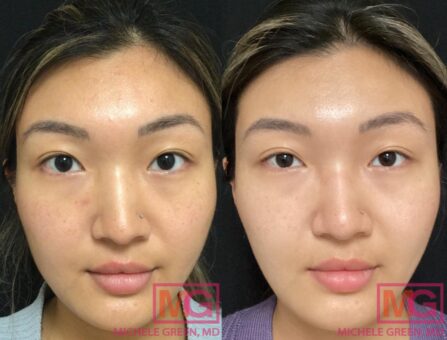 DAO Muscle Botox, What is DAO for Botox? - Dr. Michele Green M.D.