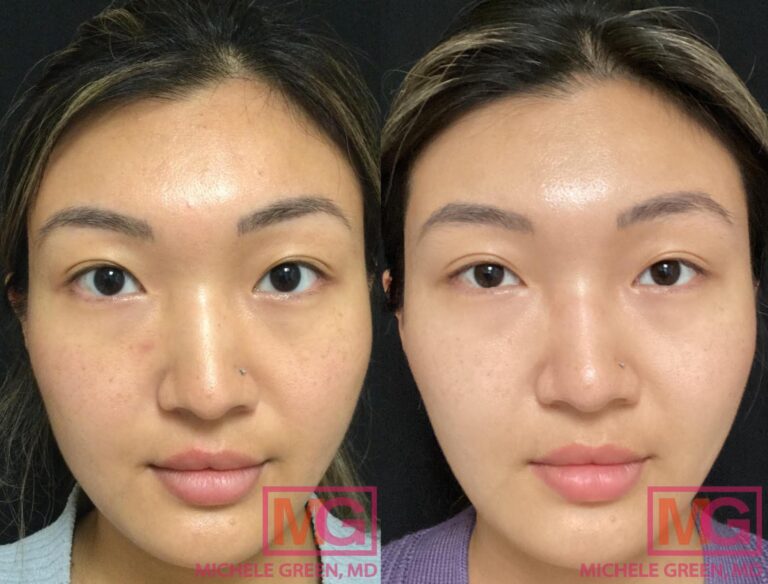 Botox TMJ (Temporomandibular Joint), TMD & Jaw Area