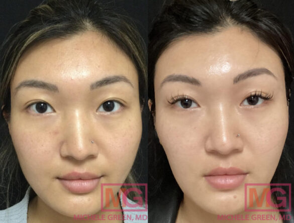 Face Slimming Botox, Botox for Facial Slimming - Dr. Michele Green M.D.