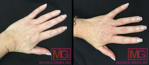Fillers for Hands, Hand Skin Care & Dermal Filler - Dr. Michele Green M.D.