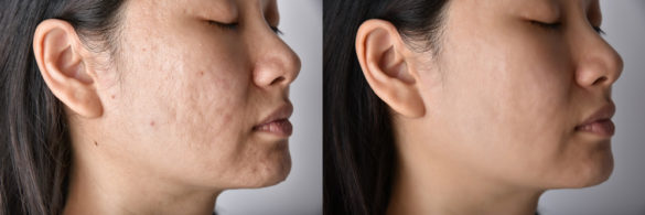 Punch Grafting & Punch Excision for Acne Scars - Dr. Michele Green M.D.