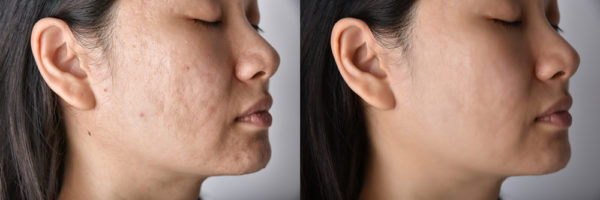 Punch Grafting & Punch Excision for Acne Scars - Dr. Michele Green M.D.