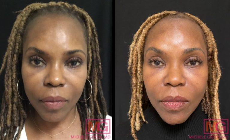 African American Skin Treatment & Dermatology NYC - Dr. Michele Green M.D.