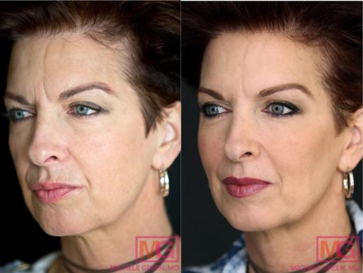 Before & After Juvederm Photos, Juvederm Voluma, Volbella, Vollure and ...