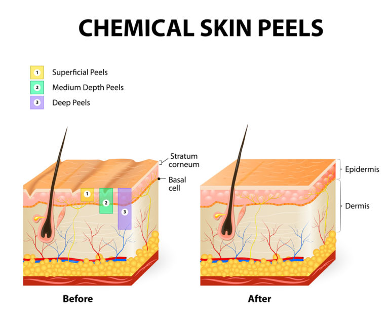 Back Acne, Causes & Treatment of Bacne - Dr. Michele Green M.D.