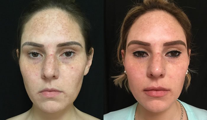 Fraxel Laser Before And After Photos - change comin