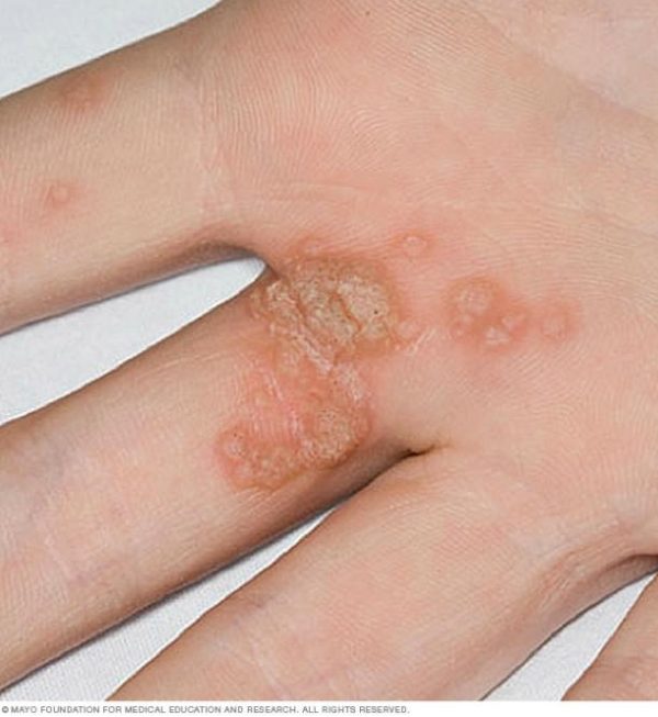 Wart Treatment, What Causes Warts, Types of Warts & Treatment NYC