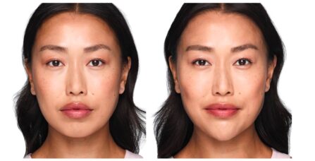 Juvederm Volux XC, Jawline Contour And Definition Filler - Dr. Michele ...