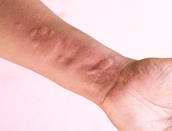 Hives Treatment NYC, Common Causes & Diagnosis - Dr. Michele Green