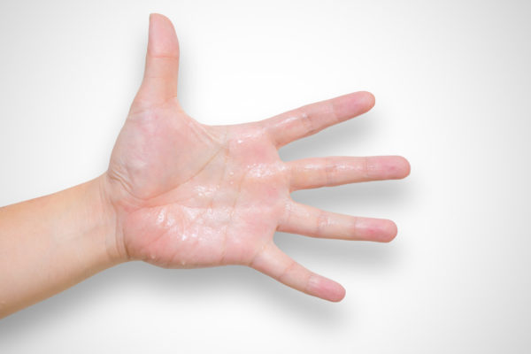 Botox for Palmar Hyperhidrosis, Botox for Sweaty Palms - Dr. Michele ...