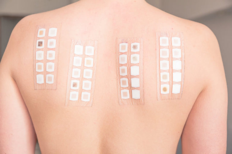 Skin Allergy Patch Testing & T.R.U.E. Tests NYC