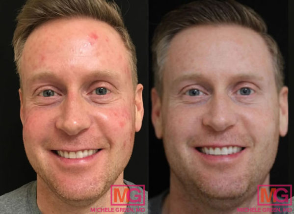 Photodynamic Therapy (PDT) & Blu-U Light for Actinic Keratoses NYC