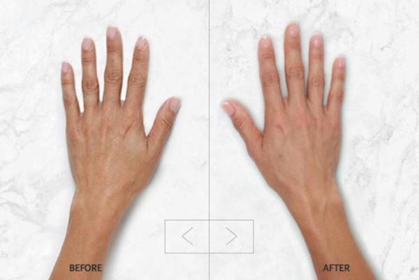 Fillers for Hands, Hand Skin Care & Dermal Filler - Dr. Michele Green M.D.