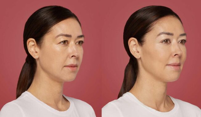 Restylane Volyme NYC for Lips, Chin, Jawline, Cheeks - Dr. Michele ...