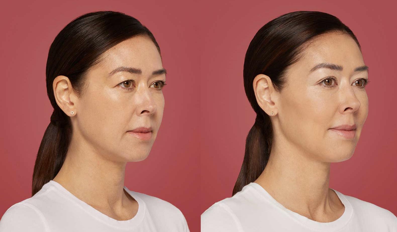 Restylane Volyme NYC for Lips, Chin, Jawline, Cheeks - Dr. Michele ...