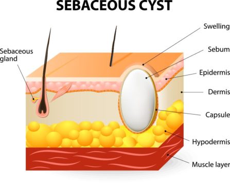 Sebaceous Cysts, What is a Sebaceous Cyst? - Dr. Michele Green M.D.