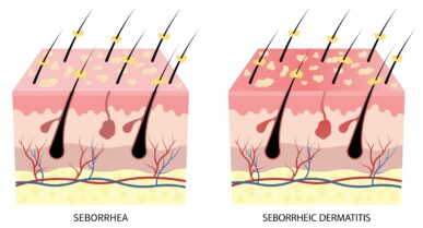 Seborrheic Dermatitis on the Scalp & Face - Dr. Michele Green M.D. NYC