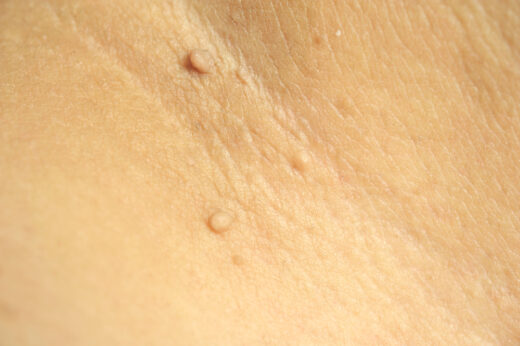 Skin Tags Neck, Causes & Removal Options - Dr. Michele Green M.D.