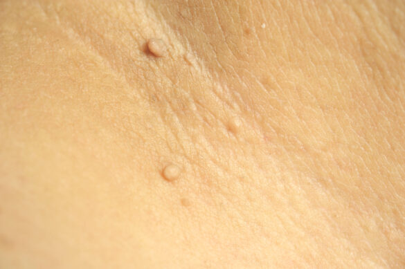 Skin Tags Neck, Causes & Removal Options - Dr. Michele Green M.D. NYC