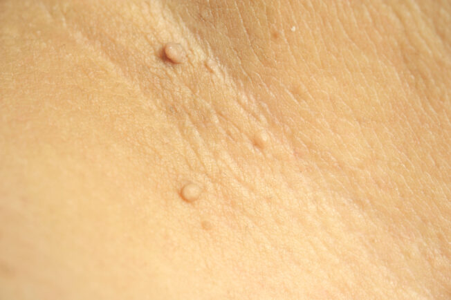 Skin Tags Neck, Causes & Removal Options - Dr. Michele Green M.D.