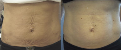 Sciton SkinTyte, BBL, Laser Skin Rejuvenation Treatment NYC